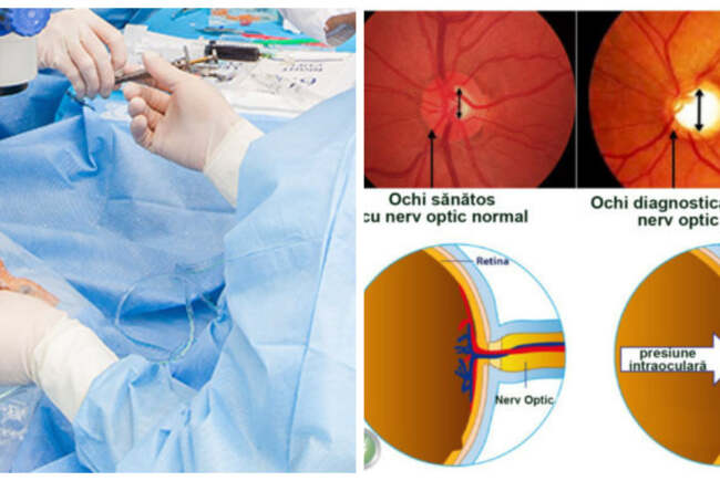 Glaucom, cauze, simptome, diagnoză și tratament - BIHON
