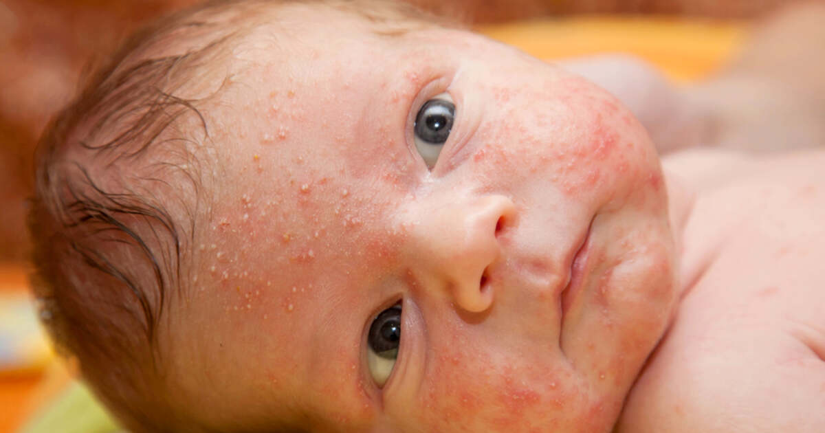 Ce este rujeola (pojarul), cum se transmite și care sunt simptomele - BIHON